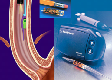 BRAVO for Reflux Monitoring – Manchester Gastro Specialists