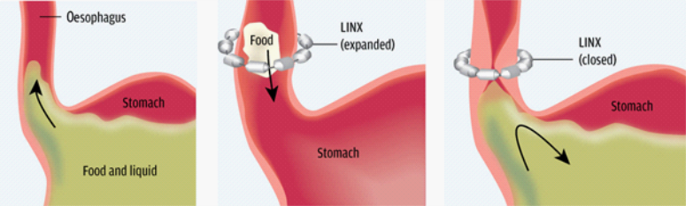 Linx for GORD – Manchester Gastro Specialists